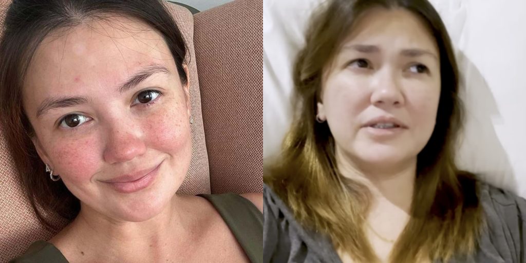 Angelica Panganiban ibinahagi ang kanyang kakaibang sakit sa buto ...